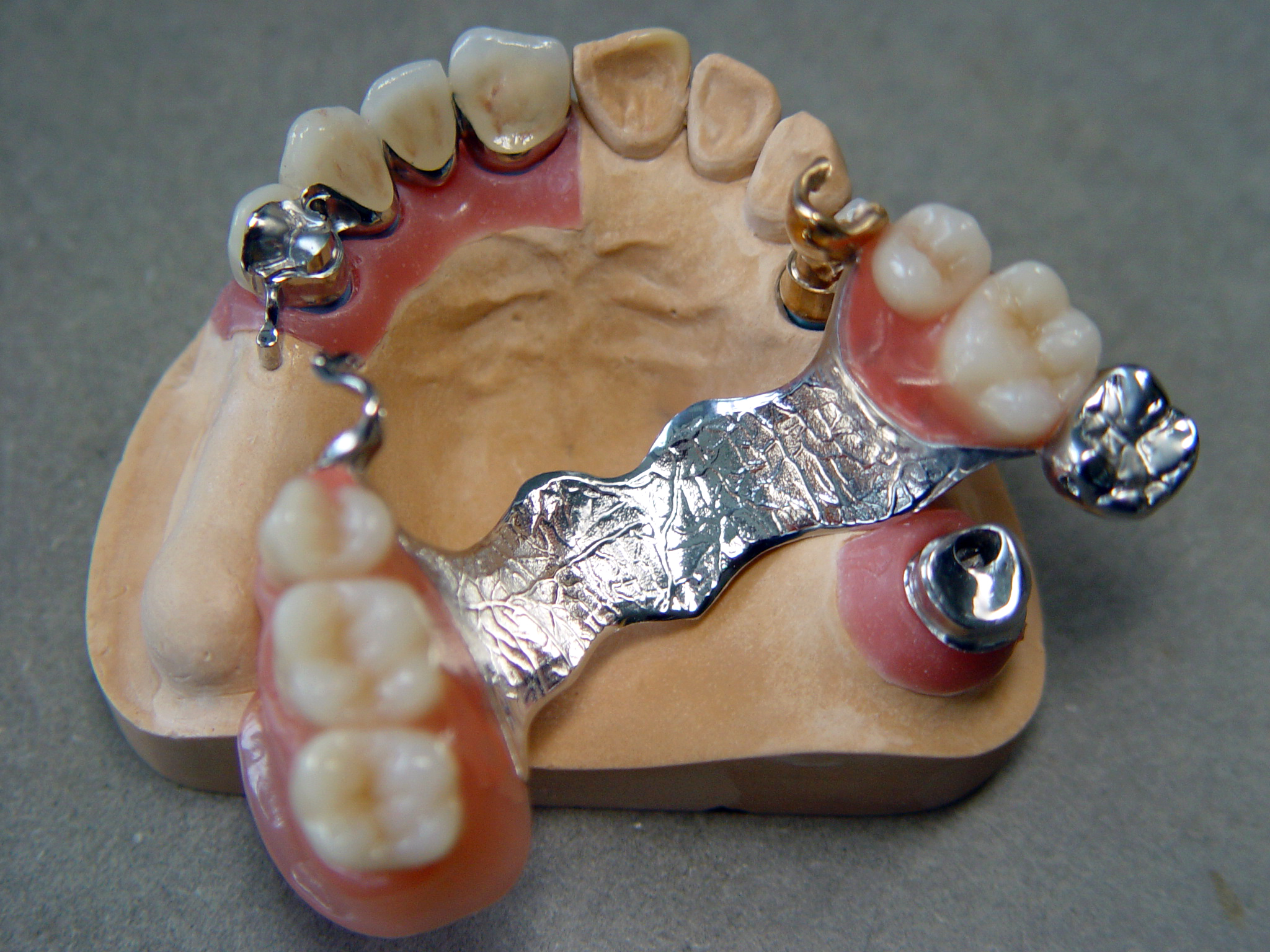 hochwertiger Zahnersatz – Dr. Schottenhammel